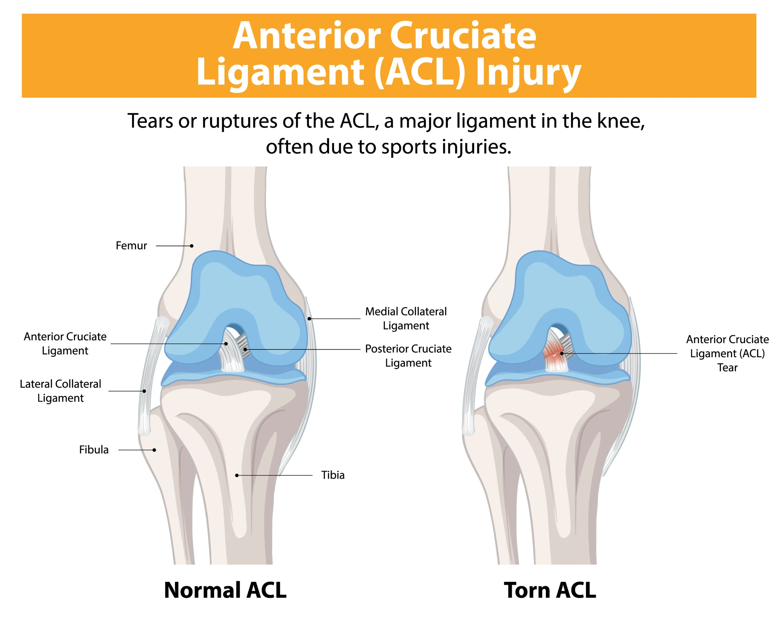 ACL Reconstruction Surgery in Indore, ACL Surgery | Dr Vikas Jain